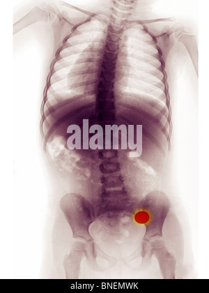 abdomen x-ray of a 7 year old girl who swallowed a quarter Stock Photo ...