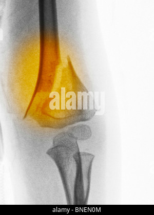 X-ray of a fracture of the distal humerus Stock Photo - Alamy