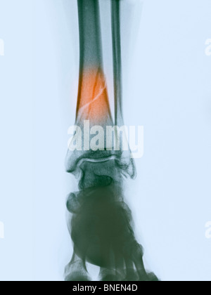 Lower leg fracture. X-ray of a fracture through the fibula (thinner ...