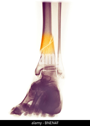 Lower leg fracture. X-ray of a fracture through the fibula (thinner ...