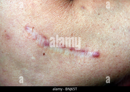 Scar on woman's right elbow. Wound was a work injury Stock Photo - Alamy