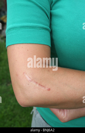 Scar on woman's right elbow. Wound was a work injury Stock Photo - Alamy