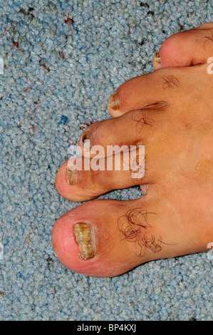 Fungal infection. View of the broken, discoloured and poorly growing ...