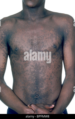 Pityriasis versicolor (tinea versicolor), a fungal infection producing ...