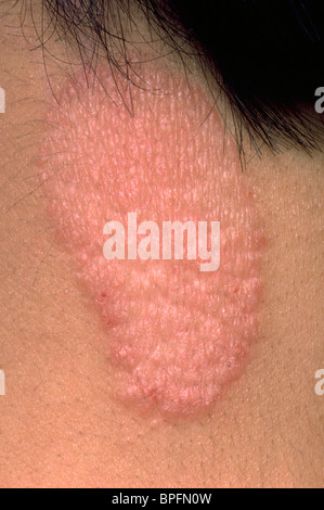 Lichen simplex chronicus Stock Photo - Alamy