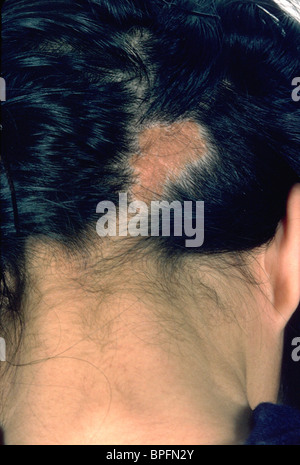 Sebaceous naevus (birthmark) on the scalp of an adult patient. This ...