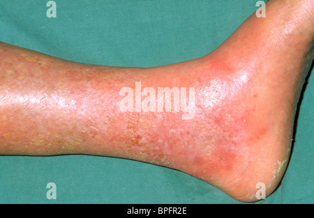 An example of necrotic lesions on the lower leg in which the ...