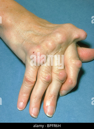 CUTANEOUS VASCULITIS IN RHEUMATOID ARTHRITIS SUFFERER Stock Photo - Alamy
