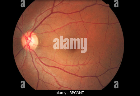 Background diabetic retinopathy or BDR is named appropriately because ...