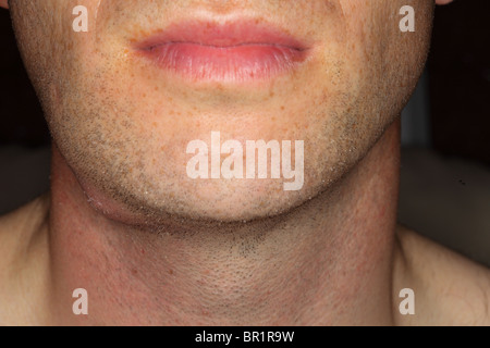 Boil or abscess of the face Stock Photo - Alamy