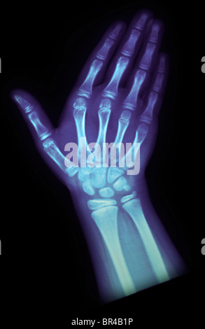 x-ray showing the hand of an 8 year old Stock Photo - Alamy