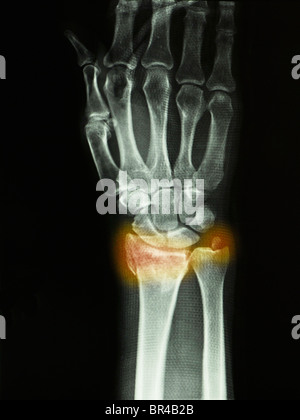 Distal radius and ulnar styloid fracture in a 43 year old man Stock ...