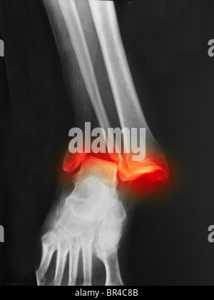 x-ray showing a fracture and dislocation of the ankle in a 64 year old ...