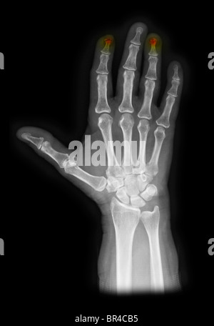 hand x-ray showing a fracture of the distal phalanx of the index finger ...