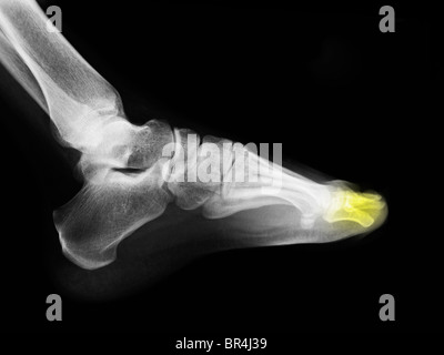 Foot x-ray of a 25 year old man showing congenital absence of the ...