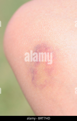 Close up of a large bruise or hematoma forming on patient arm after ...