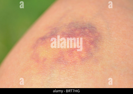 Close up of a knee with hematoma Stock Photo: 134504093 - Alamy
