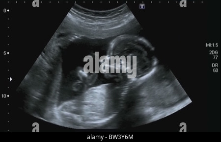 Obstetric Ultrasonography of Fourth Month Fetus Stock Photo - Alamy