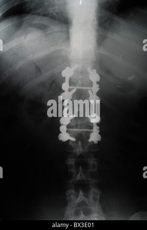 medicine back surgery Titanium Rods Titanium screws Titanium 360 degree ...