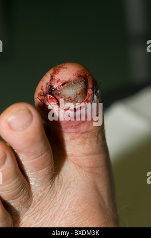 A bruised toe Stock Photo - Alamy