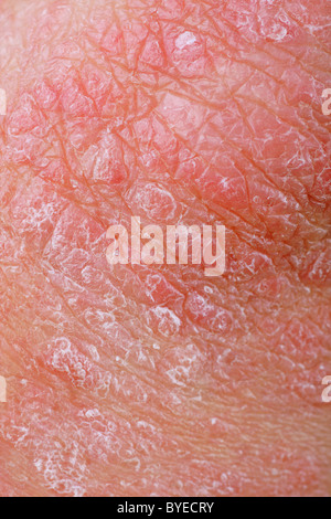 Psoriasis. Close-up of a dry flaky skin lesion on a 33-year-old male ...