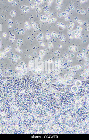 Microscope view of Colon Cancer cells in tissue culture showing walls ...
