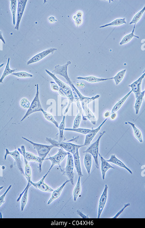 Microscope view of Prostate Cancer cells in tissue culture showing ...