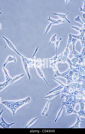 Microscope view of Prostate Cancer cells in tissue culture showing ...