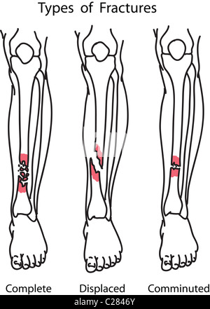 Types of bone fractures Stock Photo - Alamy