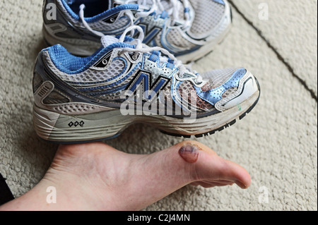 Female runner suffering with painful foot blisters after completing a ...