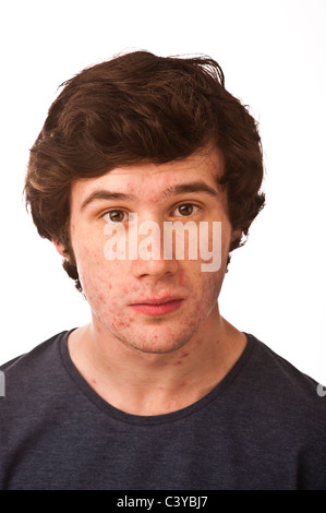 a spotty faced young man teenager youth with acne bad skin complexion ...