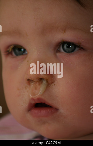 Snot in a child face close-up. Cold. Selective focus. People Stock ...