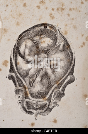 Illustration of a Human Fetus pre-birth at pelvic bone circa 1844 Stock ...