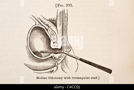 Antique Medical Illustration of Lithotomy circa 1881 Stock Photo - Alamy