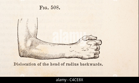 Antique medical illustration of a dislocated forearm; circa 1902 Stock ...