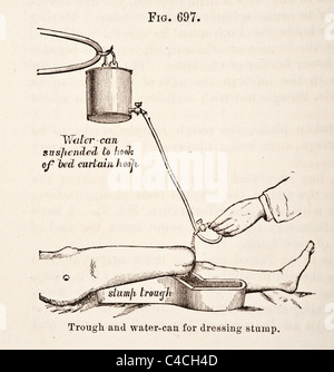 Antique Medical Illustration of Amputation(s) Procedure circa 1881 ...