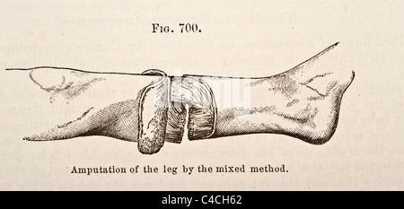 Antique Medical Illustration of Amputation(s) Procedure circa 1881 ...