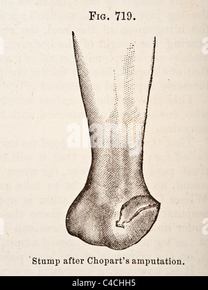 Antique Medical Illustration of Amputation(s) Procedure circa 1881 ...