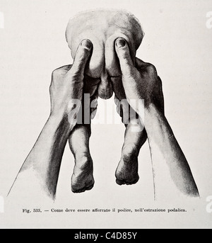 Illustration of Human Birth copyright 1905 Stock Photo - Alamy