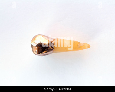 An extracted premolar tooth which had been fitted with a gold crown ...