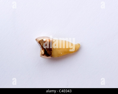 An extracted premolar tooth which had been fitted with a gold crown ...