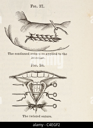 Illustration of The Quilled Suture circa 1881 Stock Photo - Alamy