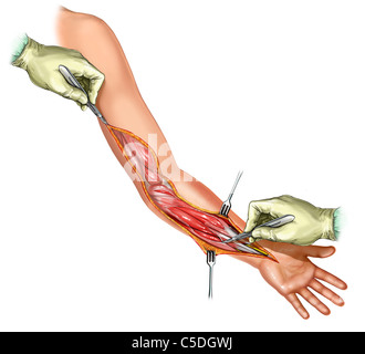 Compartment syndrome of the forearm; for fasciotomy Stock Photo ...