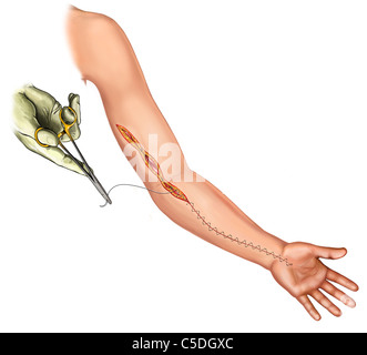 Compartment syndrome of the forearm; for fasciotomy Stock Photo ...