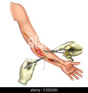 Compartment syndrome of the forearm; for fasciotomy Stock Photo ...
