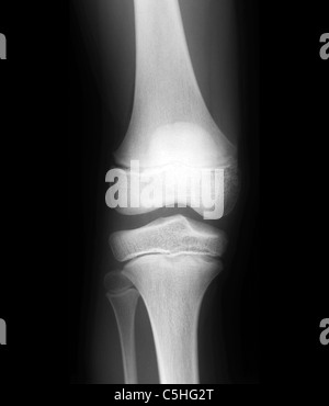 Normal child's knee, X-ray Stock Photo - Alamy