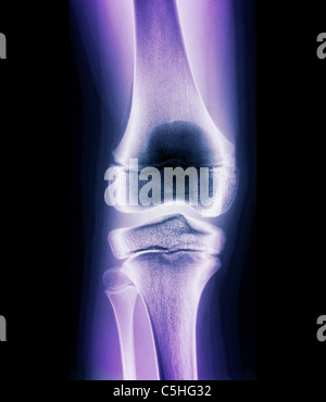 Normal child's knee, X-ray Stock Photo - Alamy