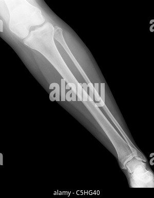 Normal lower legs, X-ray Stock Photo - Alamy