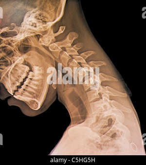 Normal extended neck, X-ray Stock Photo - Alamy