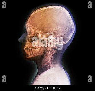 Normal child's head, X-ray Stock Photo - Alamy